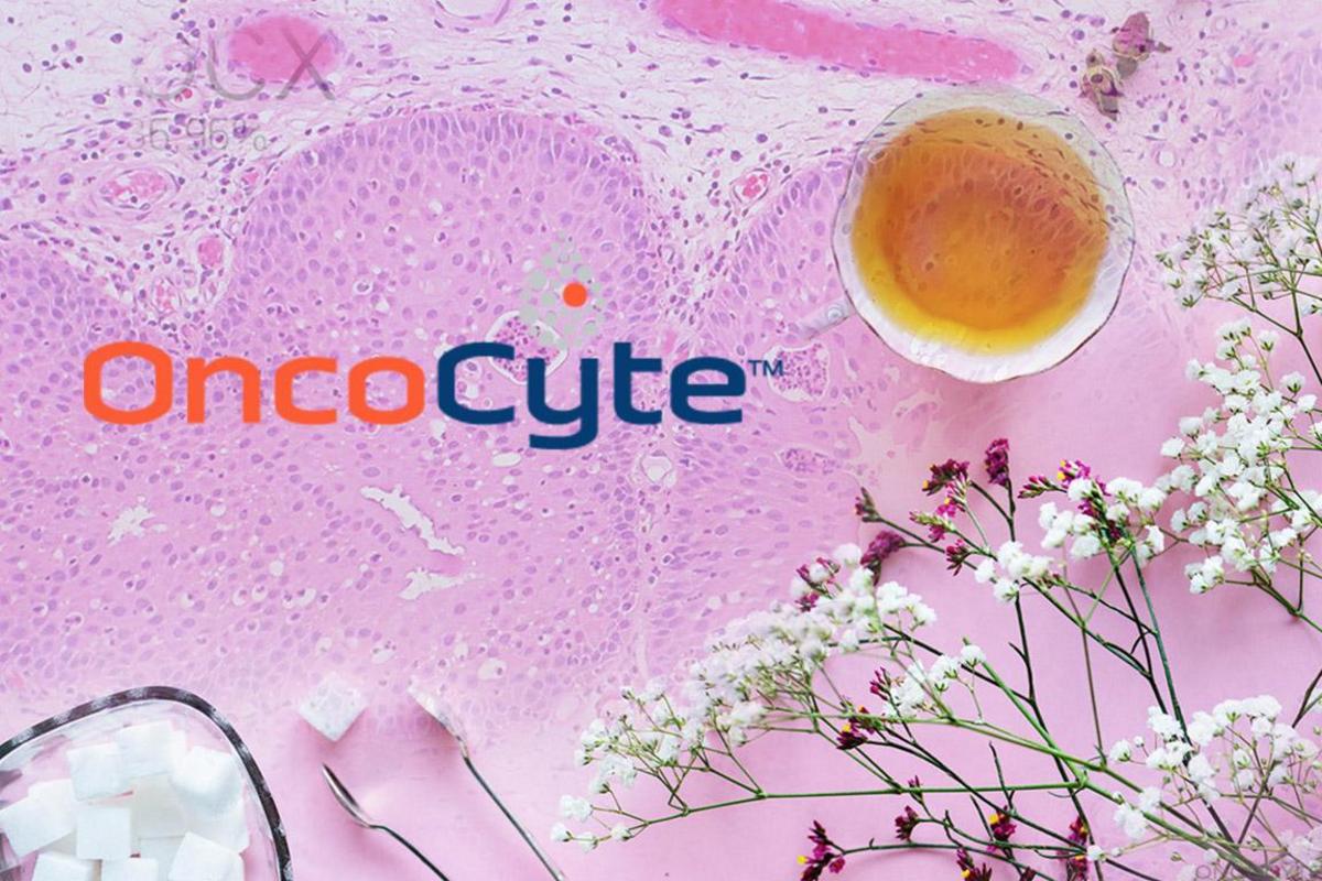 Oncocyte Soars on Licensing Deal With Chinese Firm - TheStreet